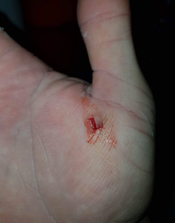 Hand injury during diving operations – IMCA